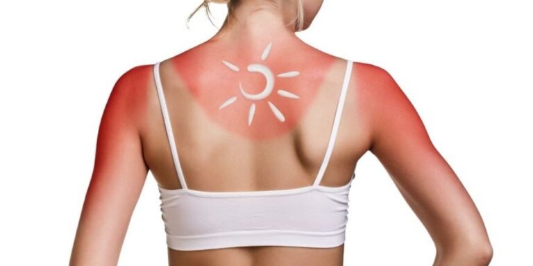 Cómo aclarar la piel quemada por el sol con remedios caseros