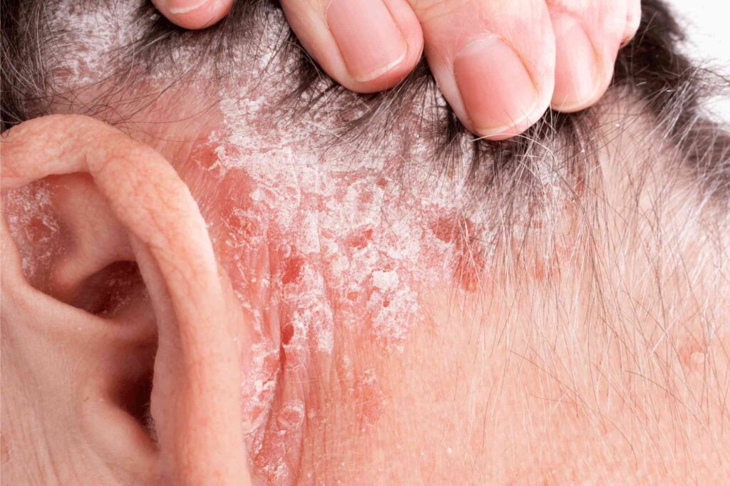 Pediculosis ¡Síntomas y prevención! - Movidatuy.com